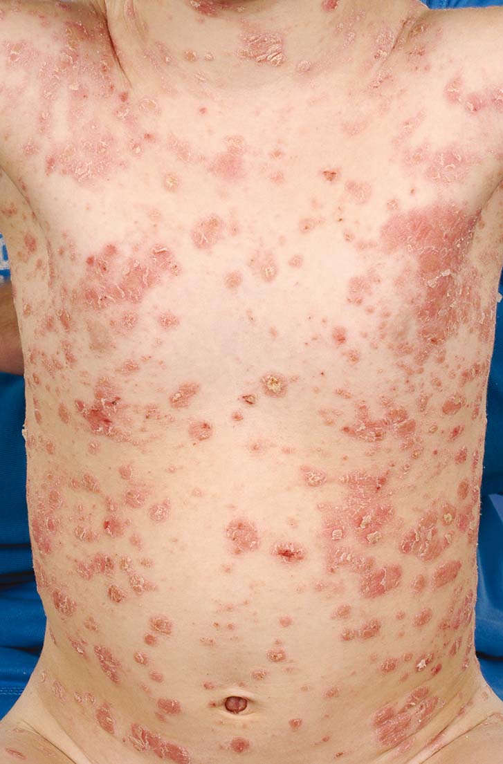8 Psoriasis en andere erythematosquameuze dermatosen | SpringerLink