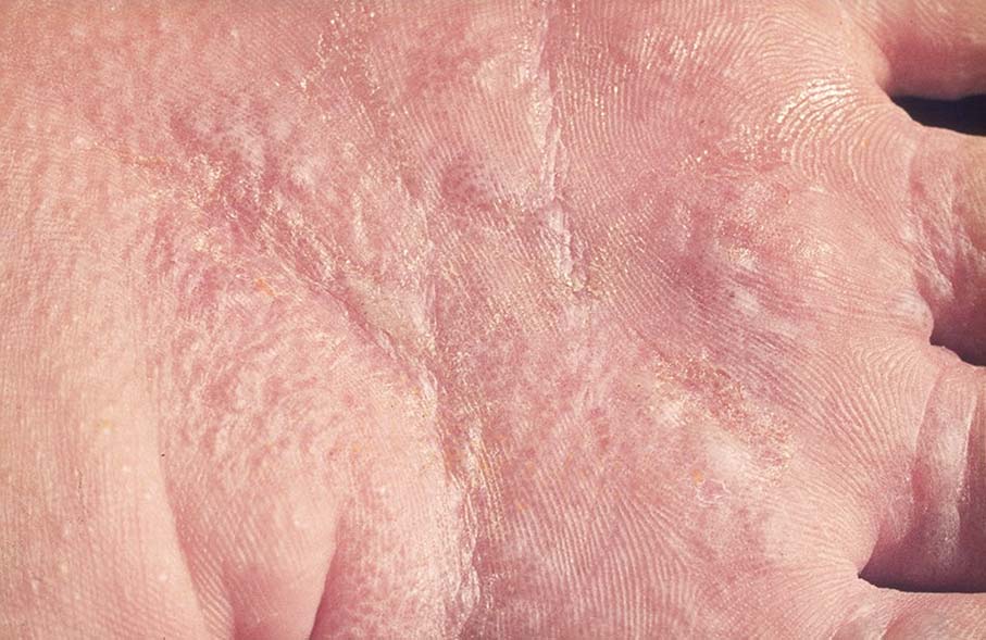 9 Eczemateuze dermatosen | SpringerLink