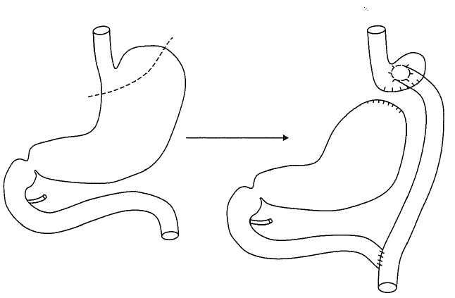 Voeding bij maagaandoeningen | SpringerLink
