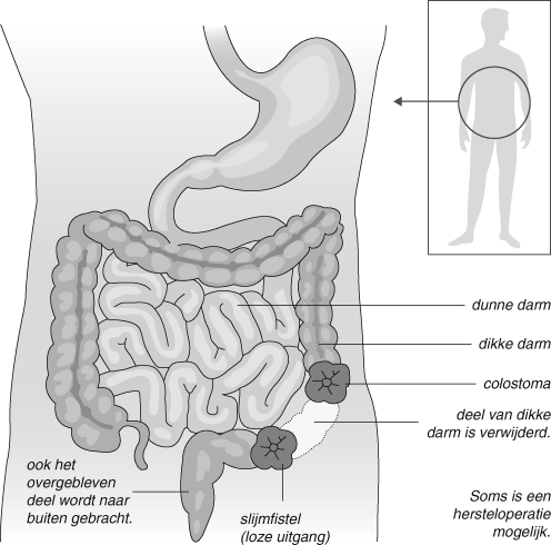 Voeding bij stoma’s | SpringerLink