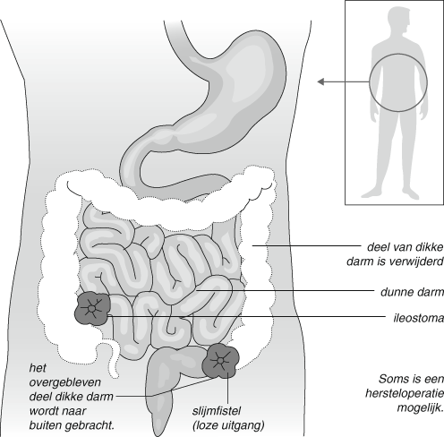 Voeding bij stoma’s | SpringerLink