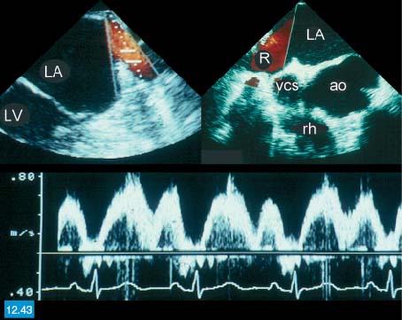 De mitralisklep | SpringerLink