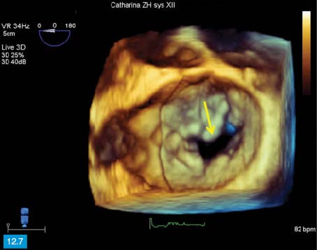 De mitralisklep | SpringerLink