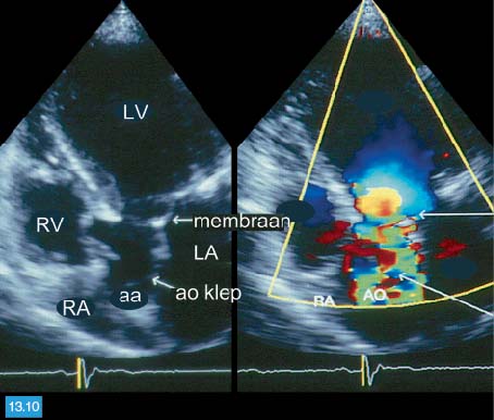 De aortaklep | SpringerLink