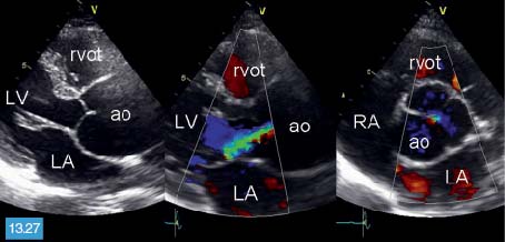 De aortaklep | SpringerLink