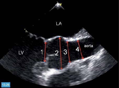 De aortaklep | SpringerLink