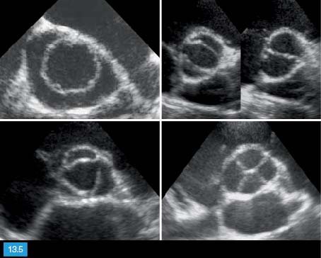 De aortaklep | SpringerLink