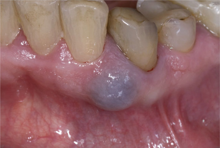 Het tandvlees en het slijmvlies van de kaakwallen | SpringerLink