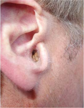 25 Prop in het oor/cerumenprop | SpringerLink