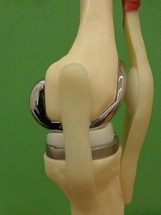 Addendum: revisie van de totale knieprothese | SpringerLink