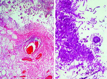 Cutaneous and Wound Aspergillosis | SpringerLink
