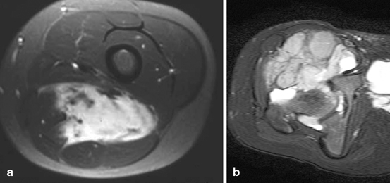Desmoid Tumors: Are They Benign or Malignant? | SpringerLink
