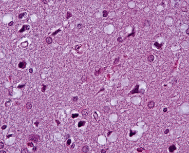 Human Prion Diseases: From Kuru to Variant Creutzfeldt-Jakob Disease ...