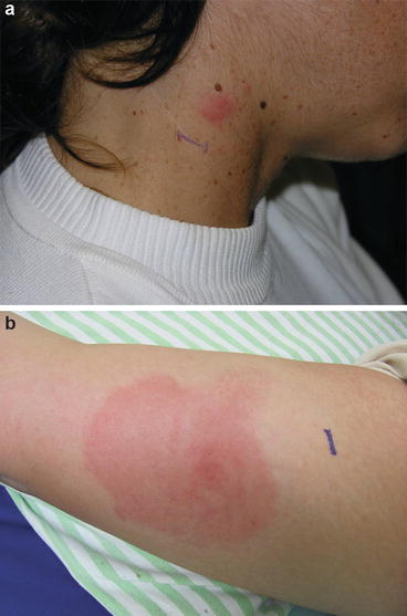 Loxosceles and Loxoscelism: Biology, Venom, Envenomation and Treatment ...