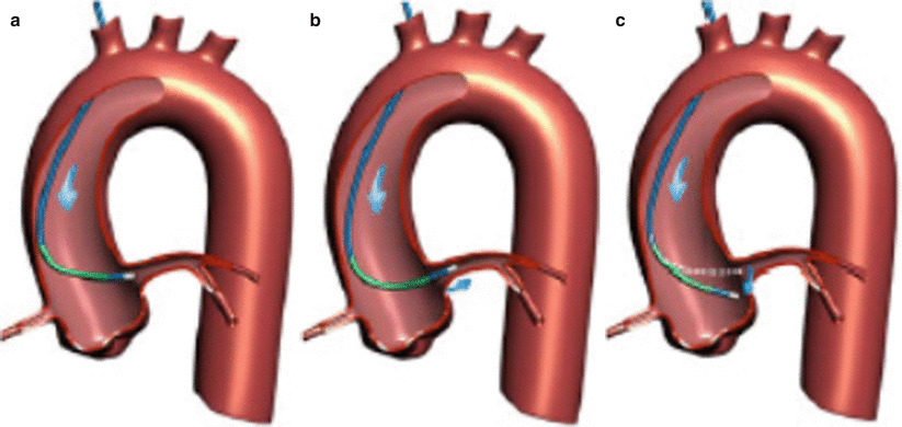 Selection and Manipulation of Guiding Catheter in Left Coronary ...