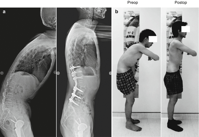 Smith-Peterson Osteotomy and Ponte Osteotomy | SpringerLink