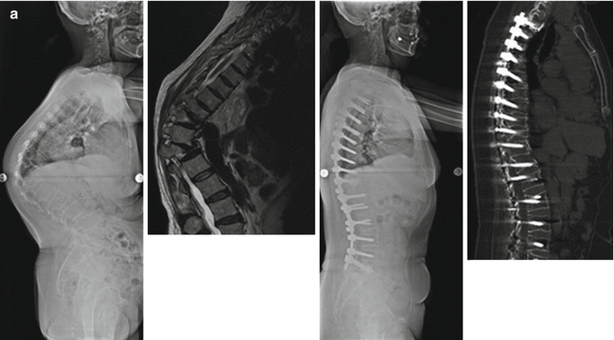 Smith-Peterson Osteotomy and Ponte Osteotomy | SpringerLink