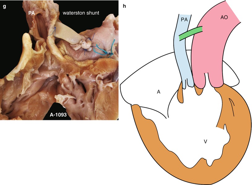 Single Ventricle | SpringerLink