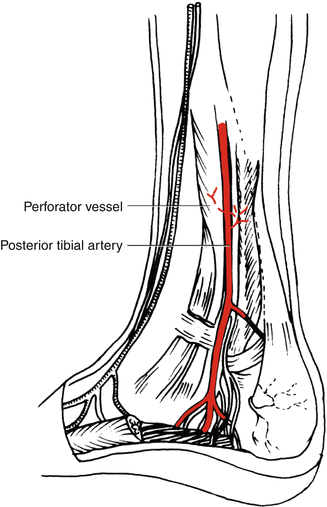 Medial Supramalleolar Perforator Flap | SpringerLink