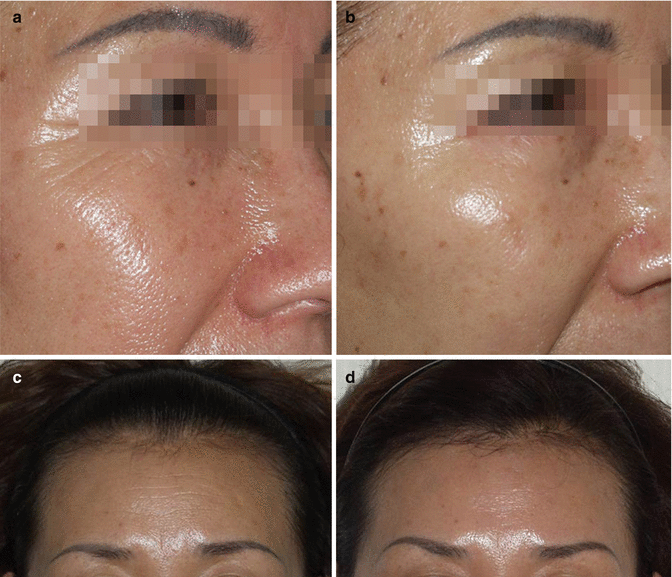 Multiple Intradermal Botulinum Toxin Injections | SpringerLink