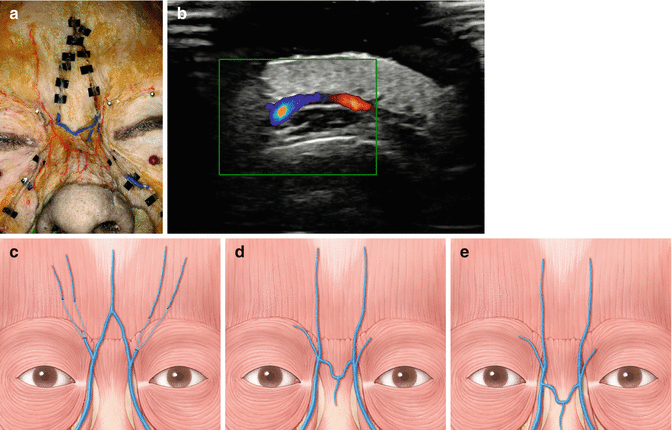 General Anatomy of the Face and Neck | SpringerLink
