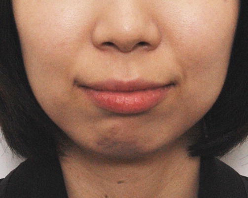 Clinical Anatomy for Botulinum Toxin Injection | SpringerLink