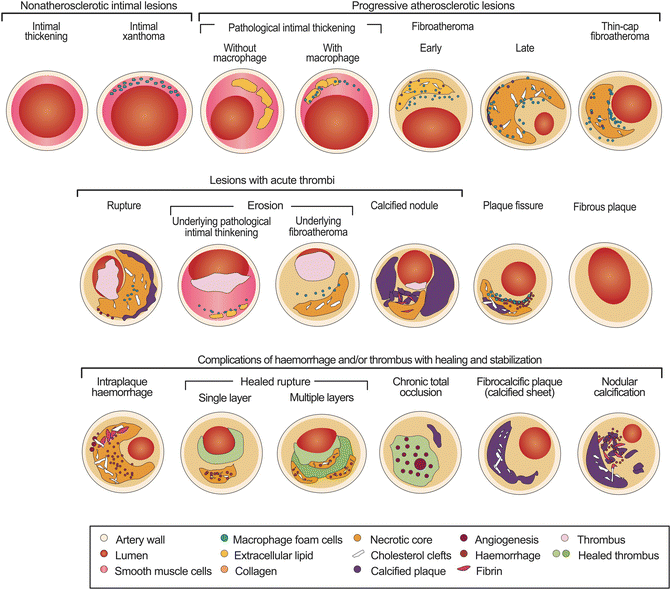 Pathophysiology of Ischemic Stroke | SpringerLink