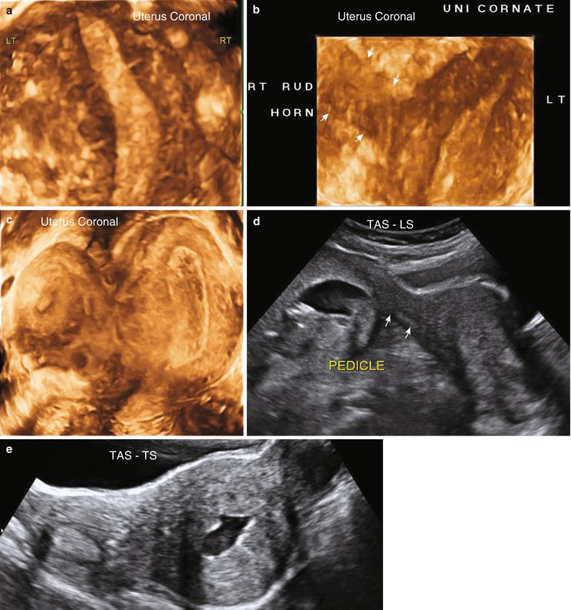 Ultrasound Evaluation of Congenital Uterine Anomalies | SpringerLink