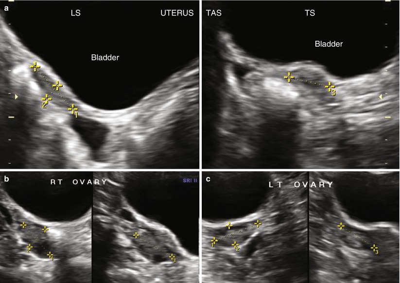 Ultrasound Evaluation of Congenital Uterine Anomalies | SpringerLink