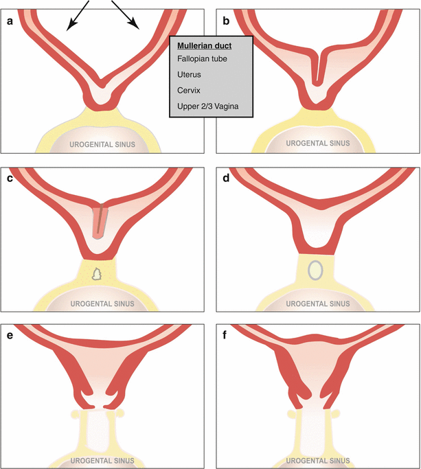 Ultrasound Evaluation of Congenital Uterine Anomalies | SpringerLink