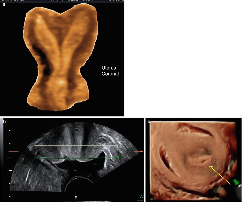 Ultrasound Evaluation of Congenital Uterine Anomalies | SpringerLink
