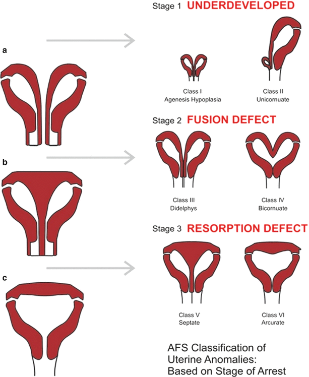 Ultrasound Evaluation of Congenital Uterine Anomalies | SpringerLink