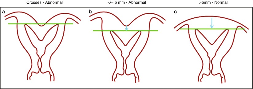 Ultrasound Evaluation of Congenital Uterine Anomalies | SpringerLink