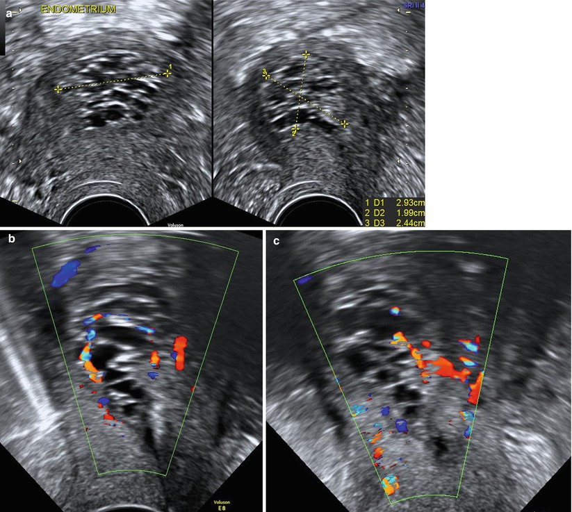 Ultrasound Evaluation of Endometrium | SpringerLink