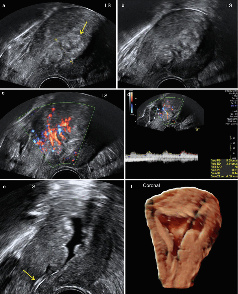 Ultrasound Evaluation of Endometrium | SpringerLink