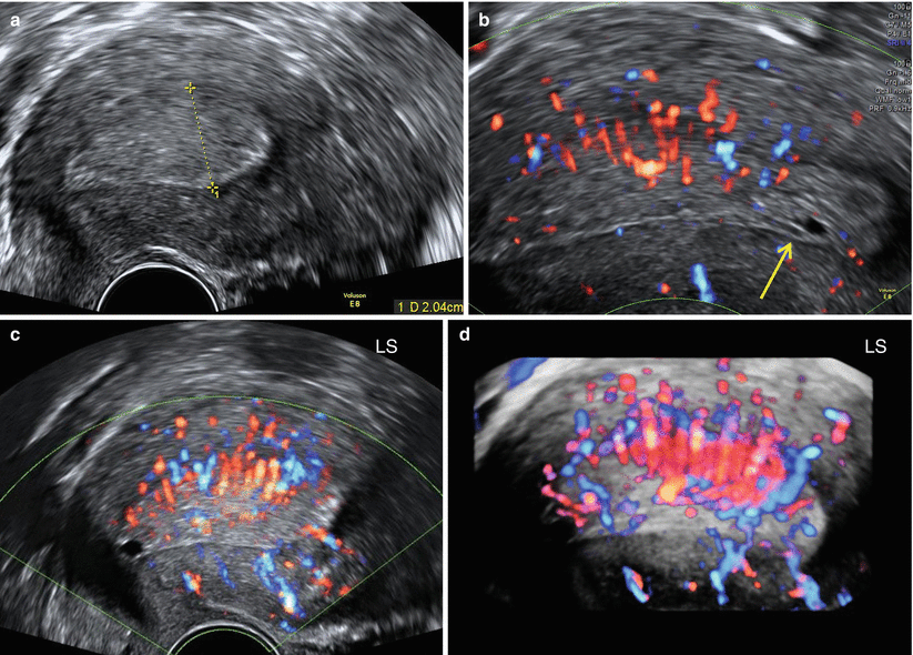 Ultrasound Evaluation Of Endometrium Springerlink