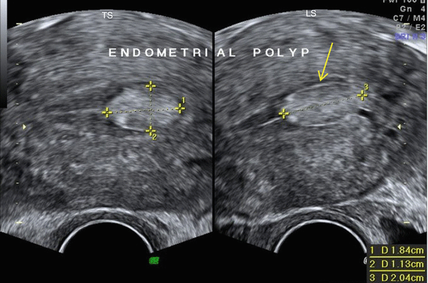 Ultrasound Evaluation of Endometrium | SpringerLink