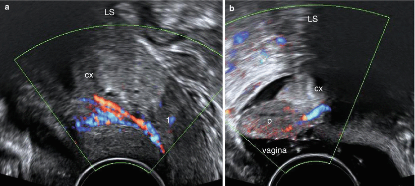Ultrasound Evaluation of the Cervix | SpringerLink