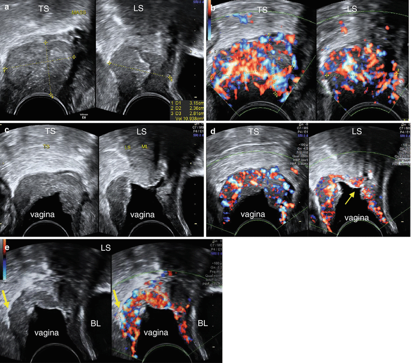 Ultrasound Evaluation of the Cervix | SpringerLink