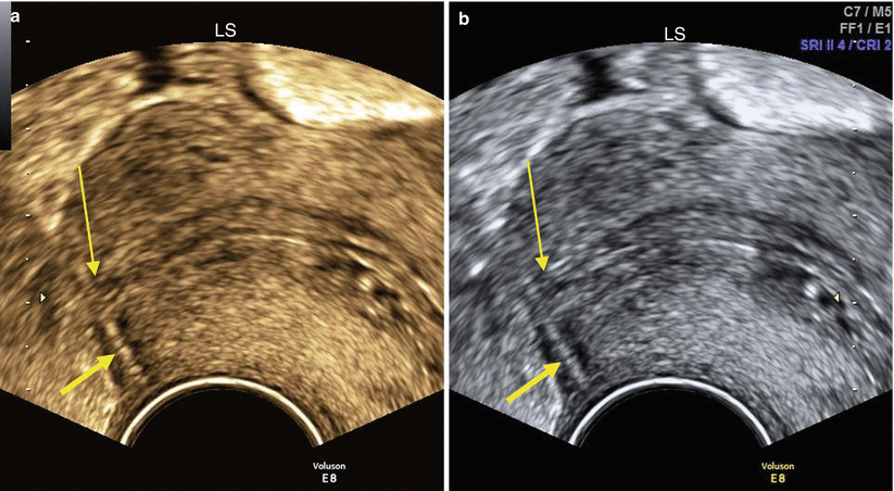 Ultrasound Evaluation of the Cervix | SpringerLink