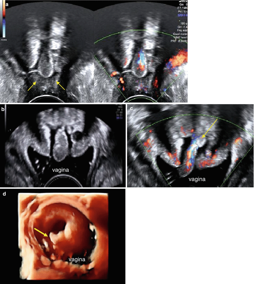 Ultrasound Evaluation of the Cervix | SpringerLink