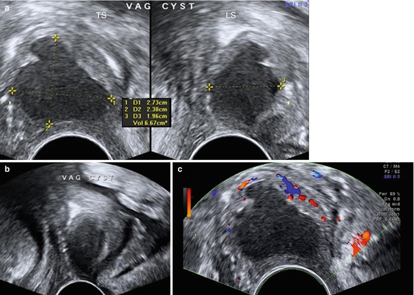 Ultrasound Evaluation of the Vagina | SpringerLink