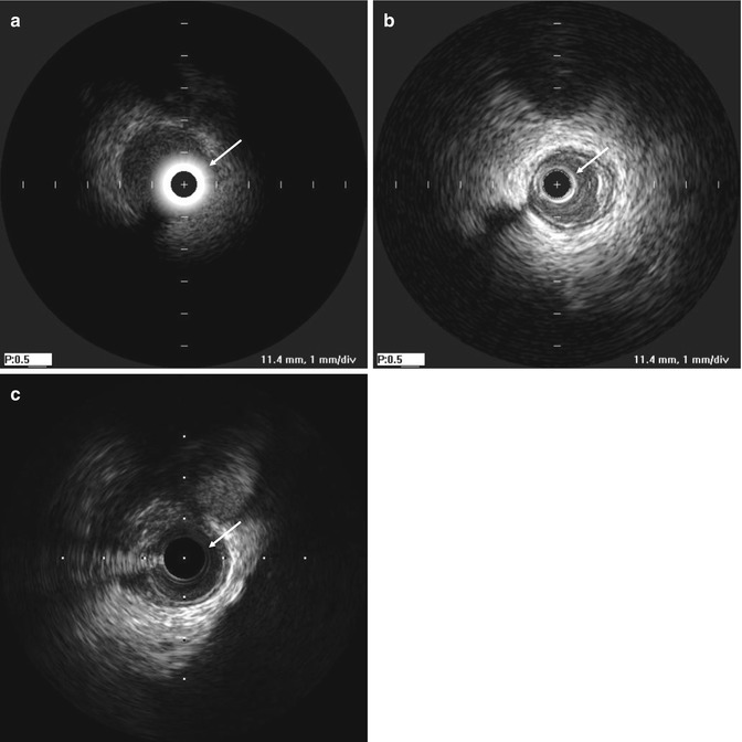 IVUS Artifacts and Image Control | SpringerLink