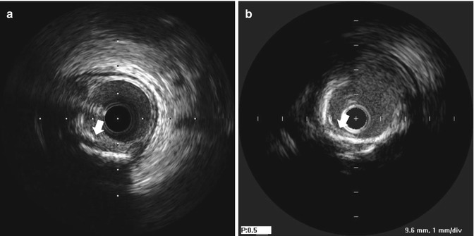 IVUS Artifacts and Image Control | SpringerLink