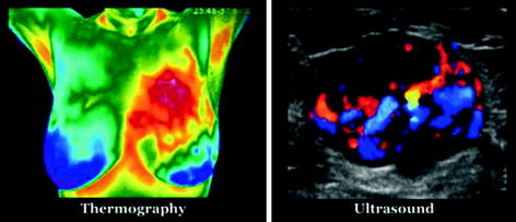 An Overview of Medical Infrared Imaging in Breast Abnormalities ...