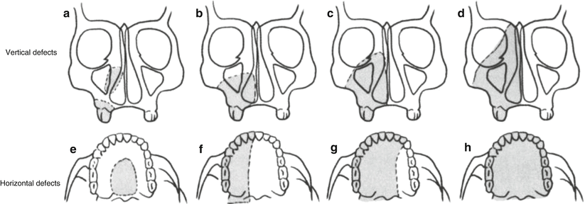 Repair and Reconstruction of Maxillary Defects | SpringerLink