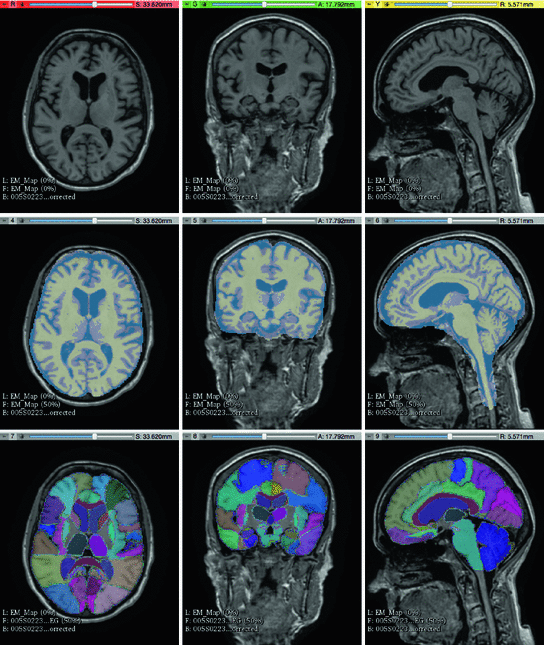 ADNI Datasets and Pre-processing Protocols | SpringerLink
