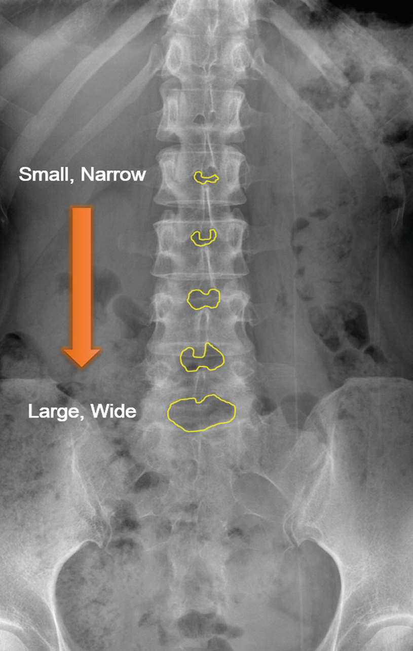 Percutaneous Full-Endoscopic Interlaminar Lumbar Spine Surgery ...
