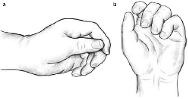 Functional Anatomy, Examination, and Functional Assessment of Hands ...