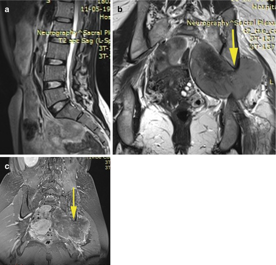 Lumbosacral Plexopathy | SpringerLink